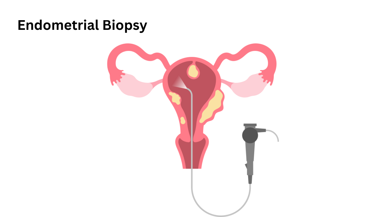 Endometrial Biopsy: A procedure to take a sample of the uterine lining ...