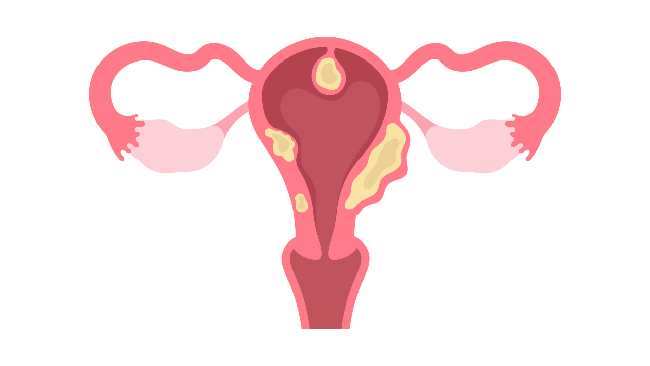 What are the symptoms of uterine fibroids? - Period Pain Clinic